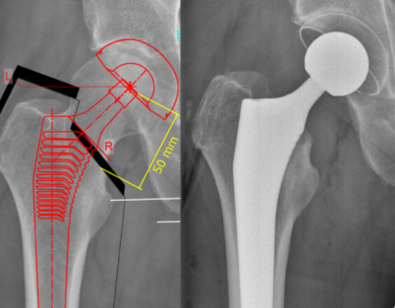 Hüftarthrose | Endoprothetik | Loretto-Krankenhaus Freiburg