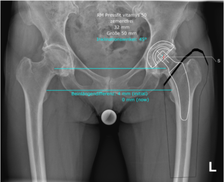 Hüftarthrose | Endoprothetik | Loretto-Krankenhaus Freiburg